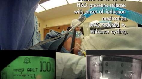 Intubation Ventilation