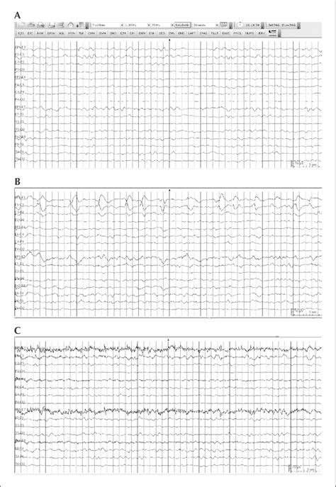 A Eeg Before Noxious Stimulation There Is Diffuse Theta Activity