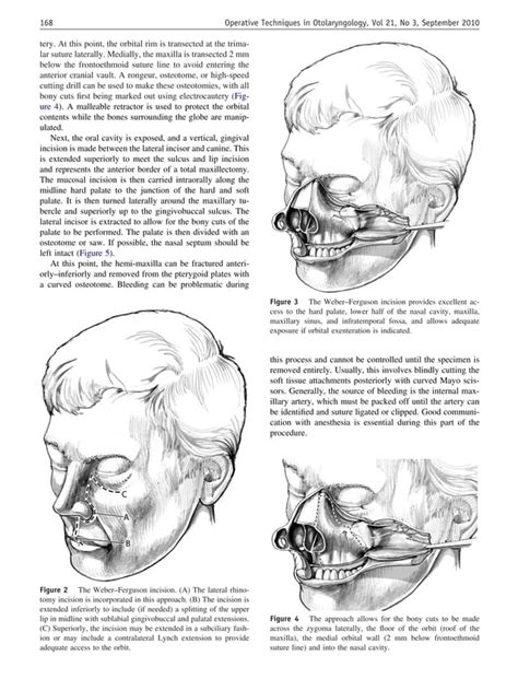 Total Maxillectomy Pdf Ear Nose And Throat Conditions Diseases
