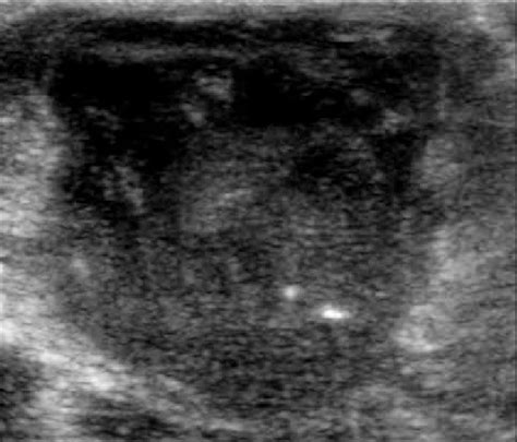 Sonogram Of Lymph Node Showing Heterogeneous Echogenicity In Case 4