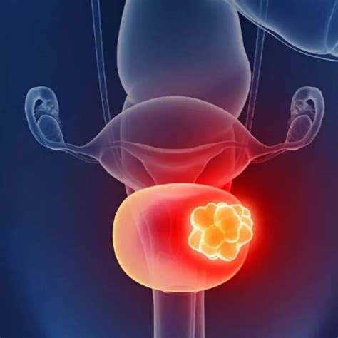 Early Warning Signs Of Bladder Cancer