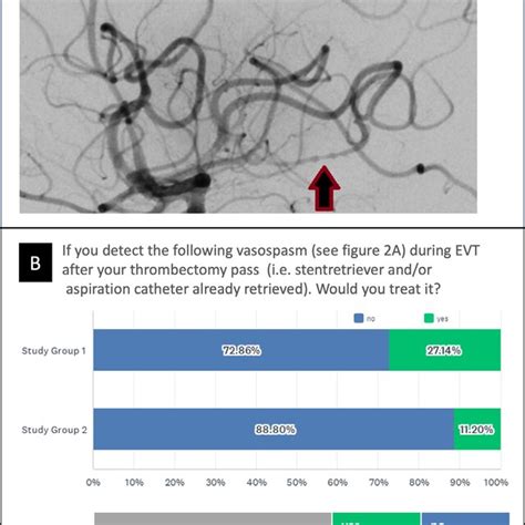 A Extracranial Vasospasm Of The Left Internal Carotid Artery