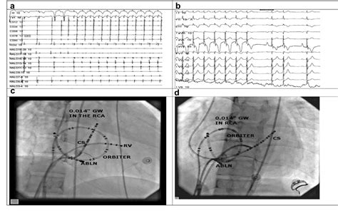 Figure 1 From Catheter Ablation Of An Elusive Accessory Pathway In Ebsteins Anomaly