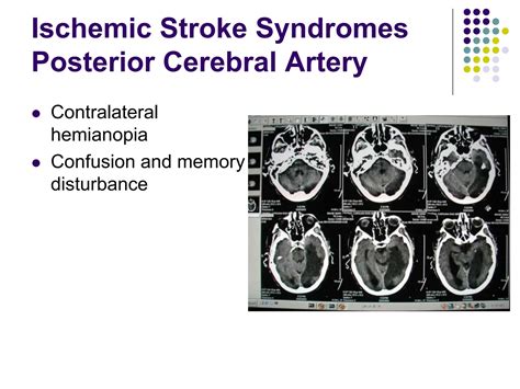 3alapproach To Cva In The Emergency Department Ppt