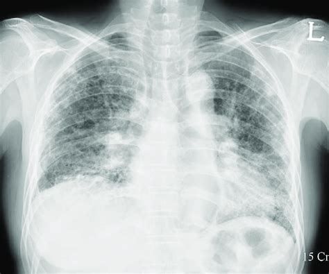 Pulmonary Fibrosis Associated With Progressive Systemic Sclerosis In A