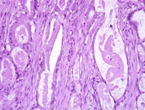 Tissue Morphology Under A Pleomorphic Adenoma Light Microscope He ×