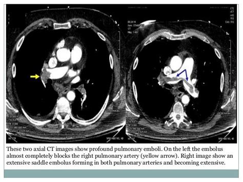 Pulmonary Embolism Radiology
