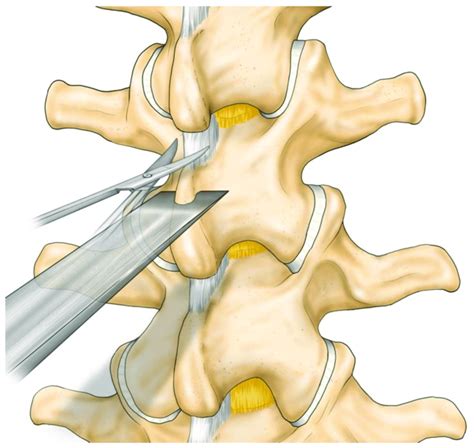 Operation Procedure 2 Excision Of The Cranial Part Of The Spinous Download Scientific Diagram