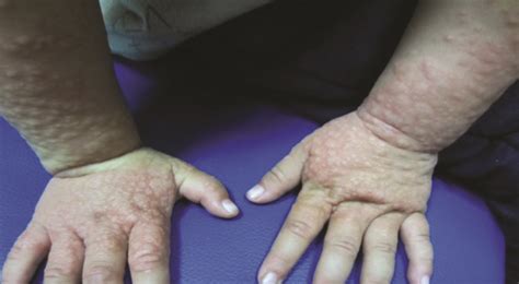 Maculopapular Rash Hands