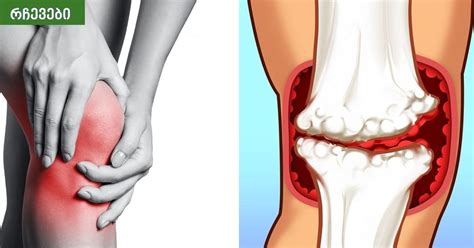 საკვები რომელიც უნდა მოიცილოთ ართრიტის დროს რადგან ისინი საზიანოა სახსრებისთვის