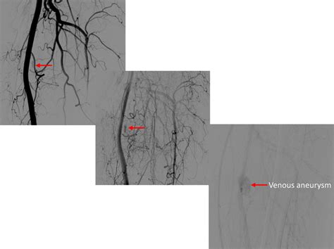 Artery Phase Venous Aneurysm Was Vaguely Enhanced In Late Artery Phase