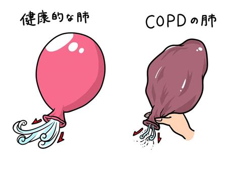Copd 肺 イラスト 260801 Copd 肺 イラスト