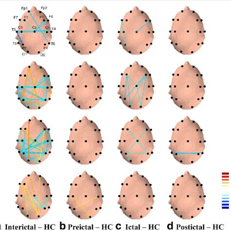 Examples Of Eeg Signals Data Are Taken From A Migraine Patient Subject Download Scientific