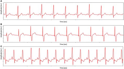 Examples Ecg From Lead Ii In Pacing Ecg Database A An Example