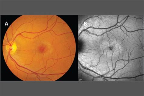 Macular Telangiectasia Types Risks And Symptoms Eye Conditions