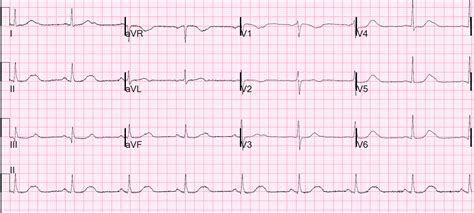 Syncope And Bradycardia Dr Smiths Ecg Blog