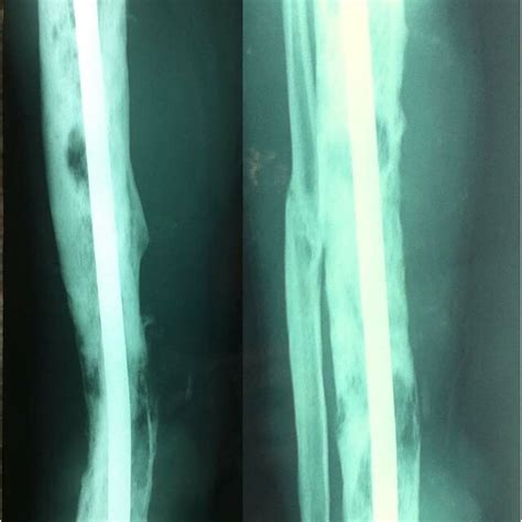 The X Ray Showed A Nail Intramedullary In The Left Tibia And Multiple Download Scientific