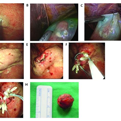 The Laparoscopic And Endoscopic Cooperative Surgery Lecs Procedures Download Scientific