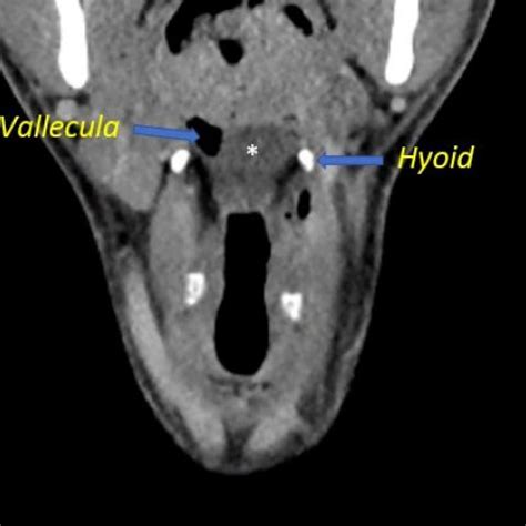 Vallecula