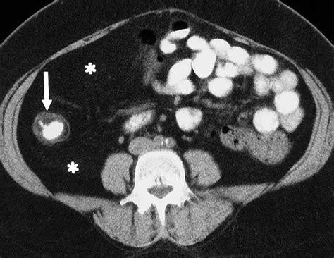 Ct Evaluation Of The Colon Inflammatory Disease Radiographics