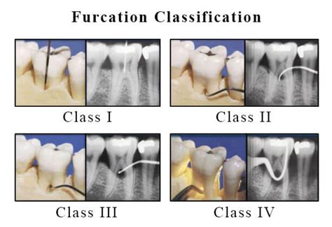 What Is Furcation Defect News Dentagama