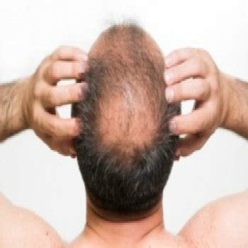 How To Get Rid Of Dry Scalp Flakes