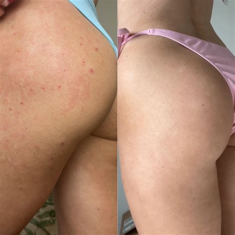 Why Do I Get Pimples On My Butt And How To Actually Treat Them