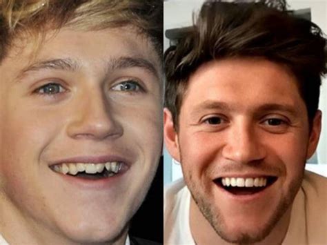 Dental Clips Usage For Teeth How They Work Lema