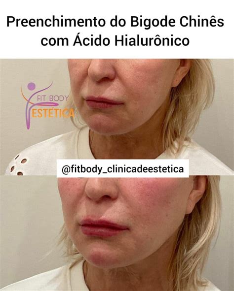 Melhor Tratamento Para Eliminar Bigode Chinês Dra Sacha