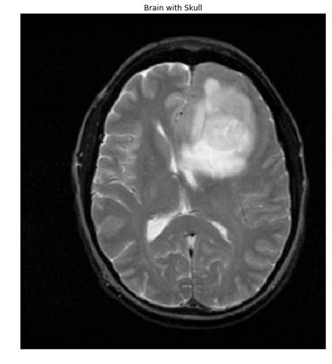 python mri brain tumor image processing and segmentation skull