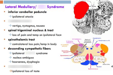 Wallenbergs Syndrome Diagram Quizlet