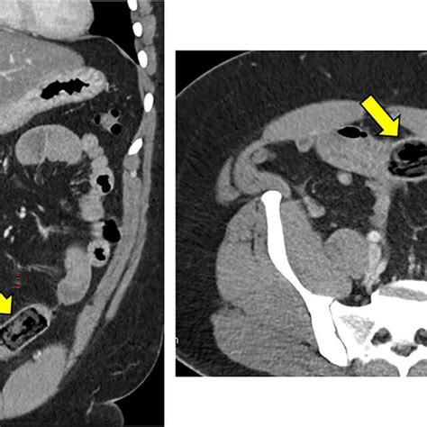 Dilated Small Bowel With A Transition Point In The Distal Small Bowel