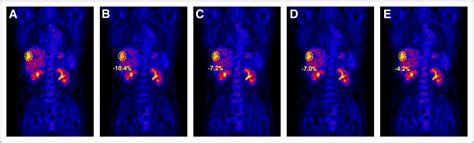 Figure 3 From Comparison Of Segmentation Based Attenuation Correction