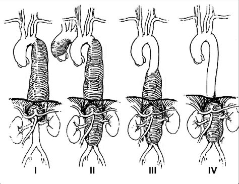 1 Crawfords Classification System Of Thoraco Abdominal Aortic