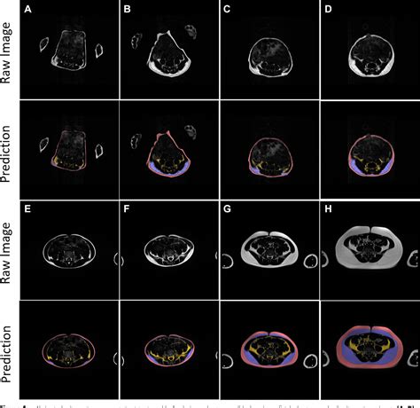 Table 1 From Automated Segmentation Of Visceral Deep Subcutaneous And Superficial Subcutaneous