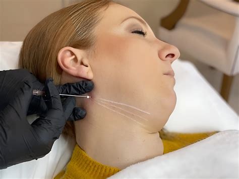 Pdo Threading Pdo Threads Threadlift Skin Renewal