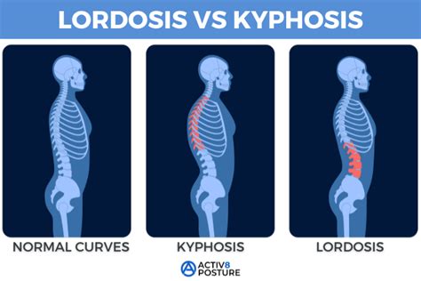 Lordosis Kyphosis Scoliosis