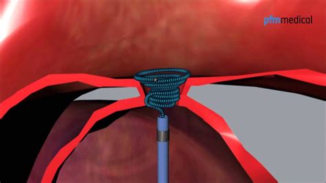 Pda Defect Pfm Medical Gmbh