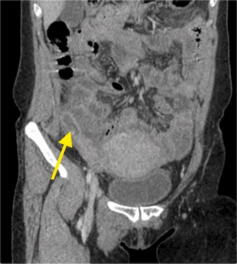 Recurrent Appendicitis Of Vermiform Appendix After A Prior Appendectomy A Case Report And