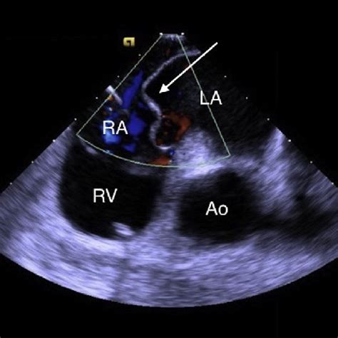 Ice Home View With Color Doppler Showing Large Intra Atrial Septum