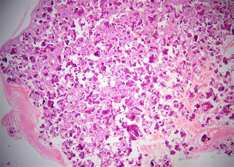 Pathology Outlines Cemento Ossifying Fibroma Ossifying Fibroma