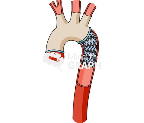 Free Aortic Total Arch Replacement Icons Symbols Pictures And Images