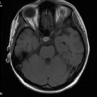 Mr Imaging In Neonate T1 Weighted Image In Axial Plane The Pituitary