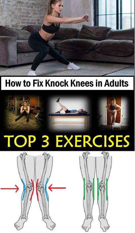 Genu Valgum Exercises