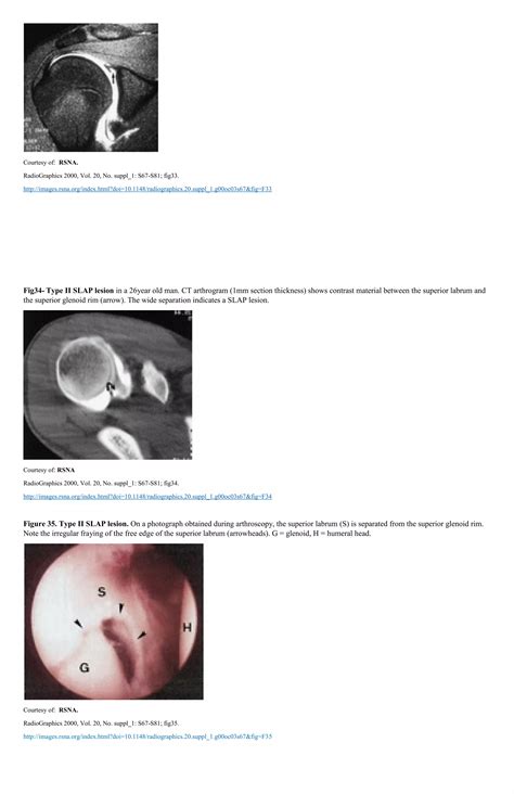 Normal Labral Variant Figures Ii Walif Chbeir Pdf
