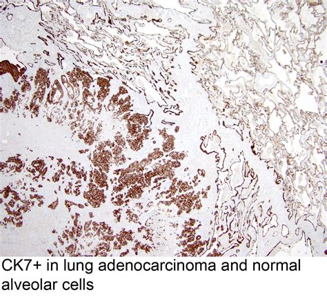 Pathology Outlines Cytokeratin 7 Ck7 K7