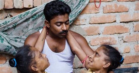 샴쌍둥이 자매와 사랑에 빠진 남성 화제