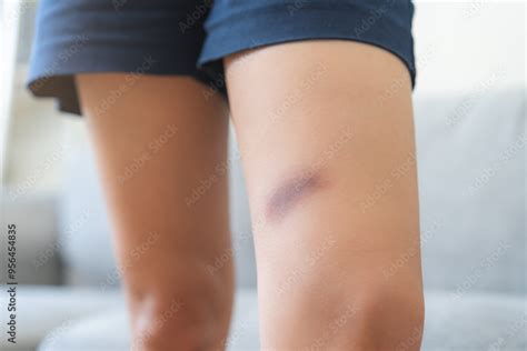 Damage Of Stain Bruise Wound On Arm Contusion Asian Young Woman Girl