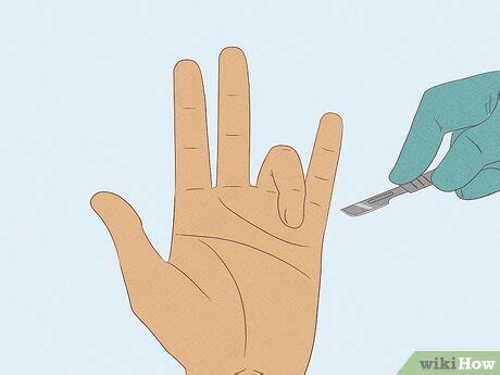 How To Treat Trigger Finger 8 Steps With Pictures WikiHow