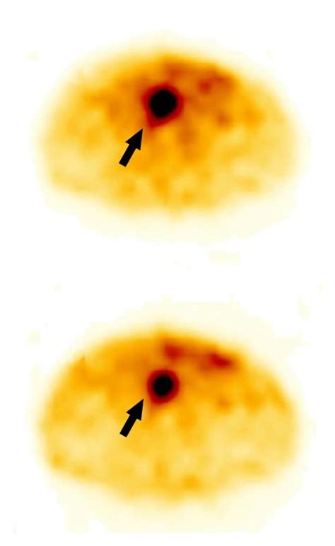 56 Year Old Woman After Ileum Resection For Carcinoid 15 Months Ago Download Scientific